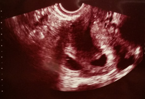 Twins at 6 Weeks: What's Like in Ultrasound Pictures? - New Kids Center