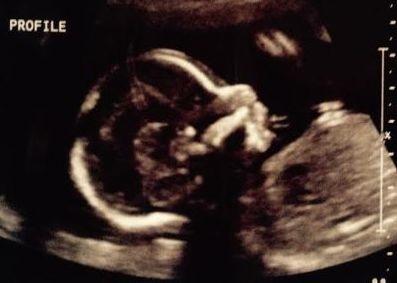 What to Expect with Ultrasound Done at 19th Week of Pregnant with ...