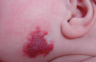 7 Causes of Baby Skin Discoloration and Ways to Help - New Kids Center
